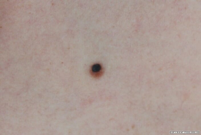 Blue Nevus - South East Skin Clinic