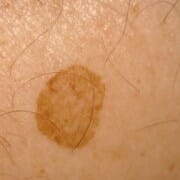 LPLK - South East Skin Clinic