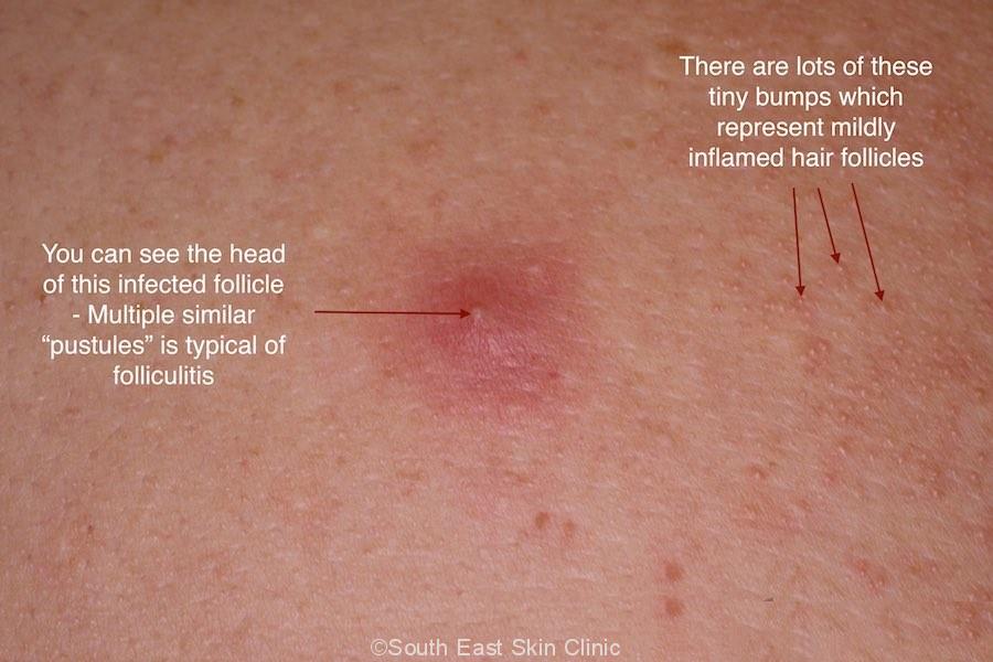 Folliculitis A Term Many Australians Are Familiar With But Why folliculitis-a-term-many-australians-are-familiar-with-but-why